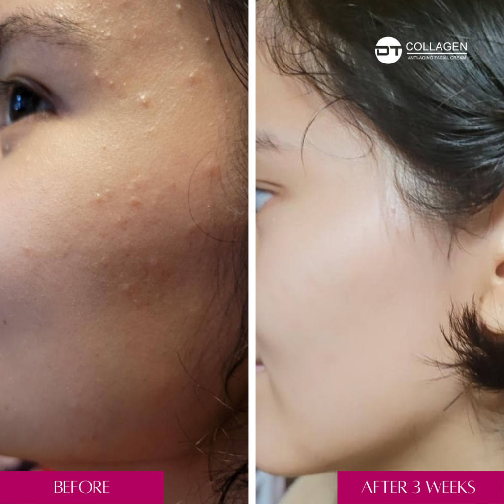 Treating Acne: AHA, BHA, Benzoyl Peroxide, Retinols and Tea Tree Oil ...
